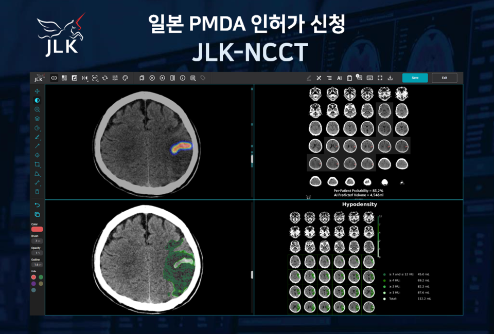 제이엘케이 'JLK-NCCT'일본 PMDA 신청 완료..뇌졸중 AI 시장 정조준